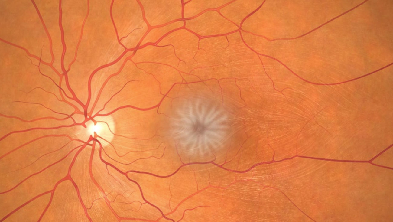 Diabetic Macular Edema: Is It Serious? Symptoms, Risks & Treatment