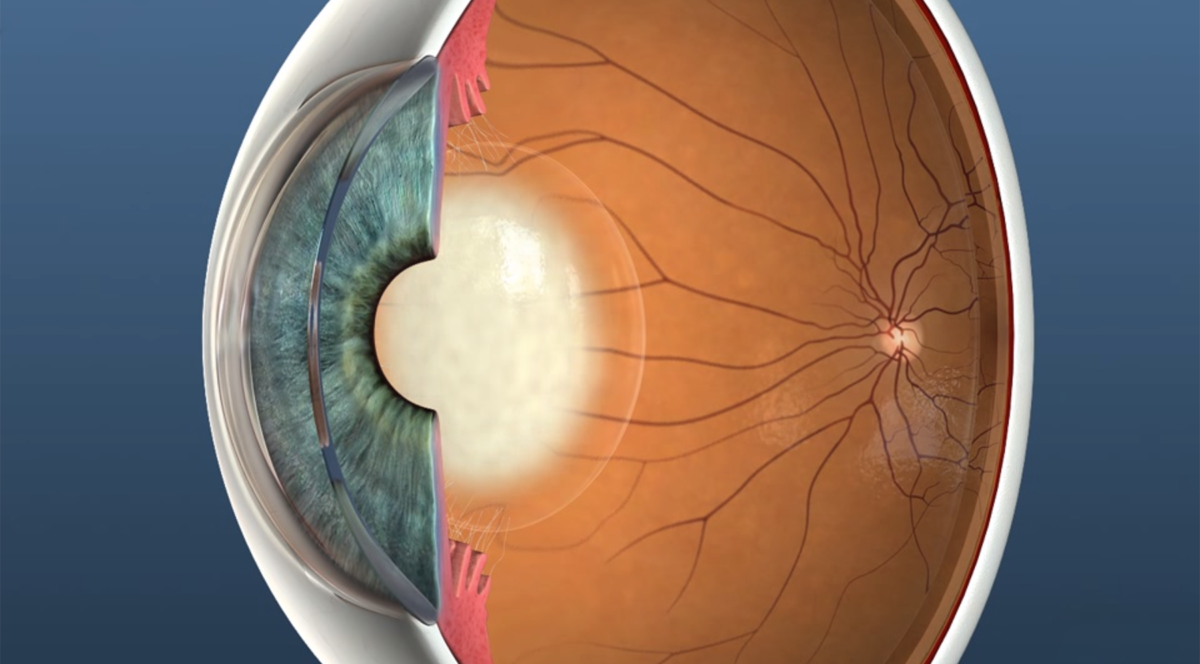 How to Prevent Cataracts? | 7 Simple Steps for Cataract Prevention