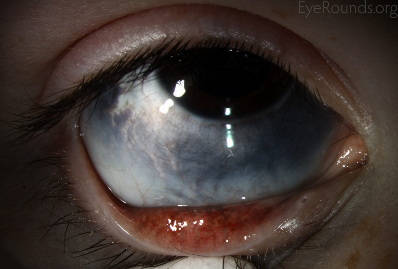 Dark Spots on Whites of Eyes: Causes & Treatments